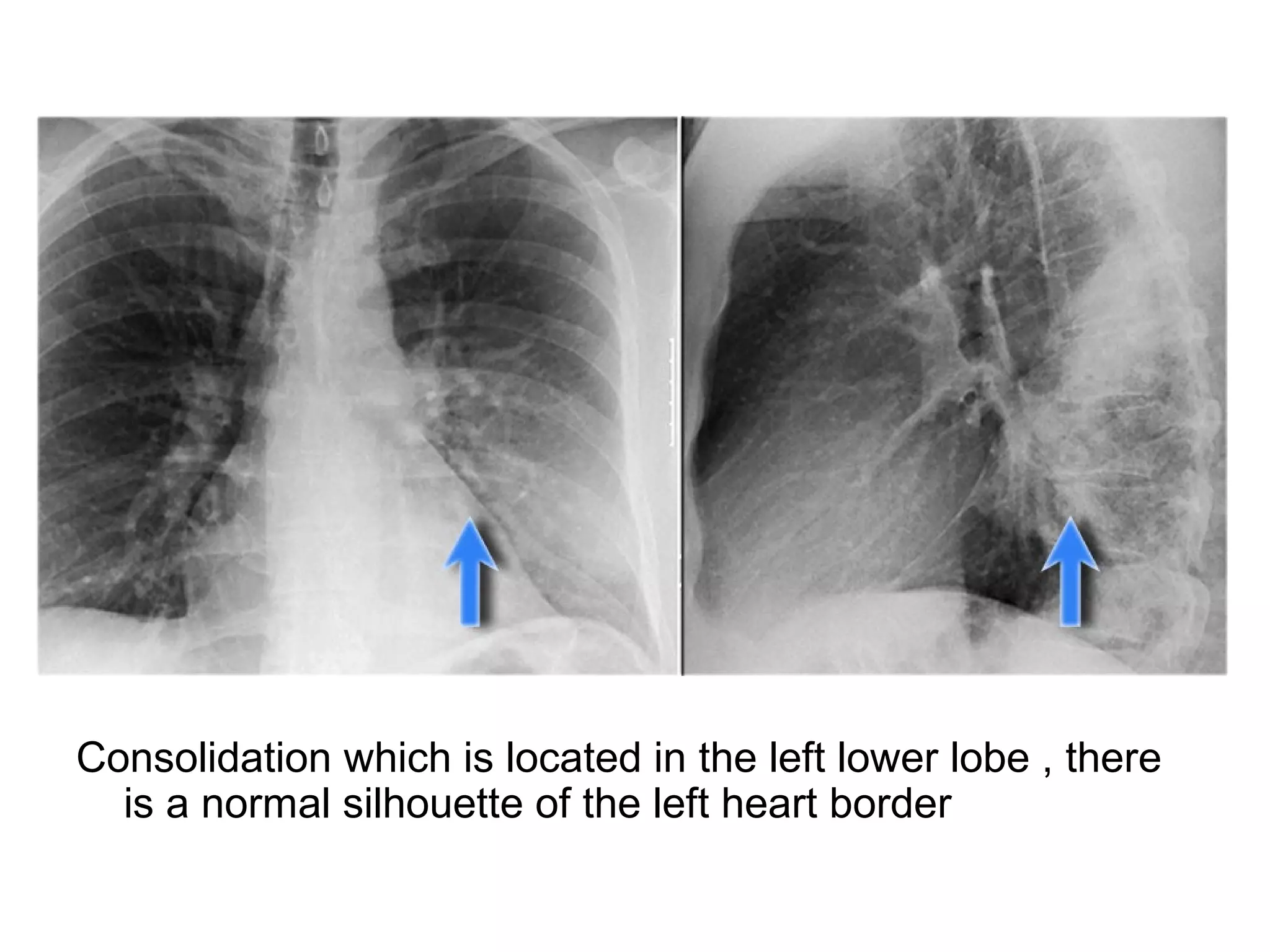 Chest X-rays Basic Interpretation | PPT