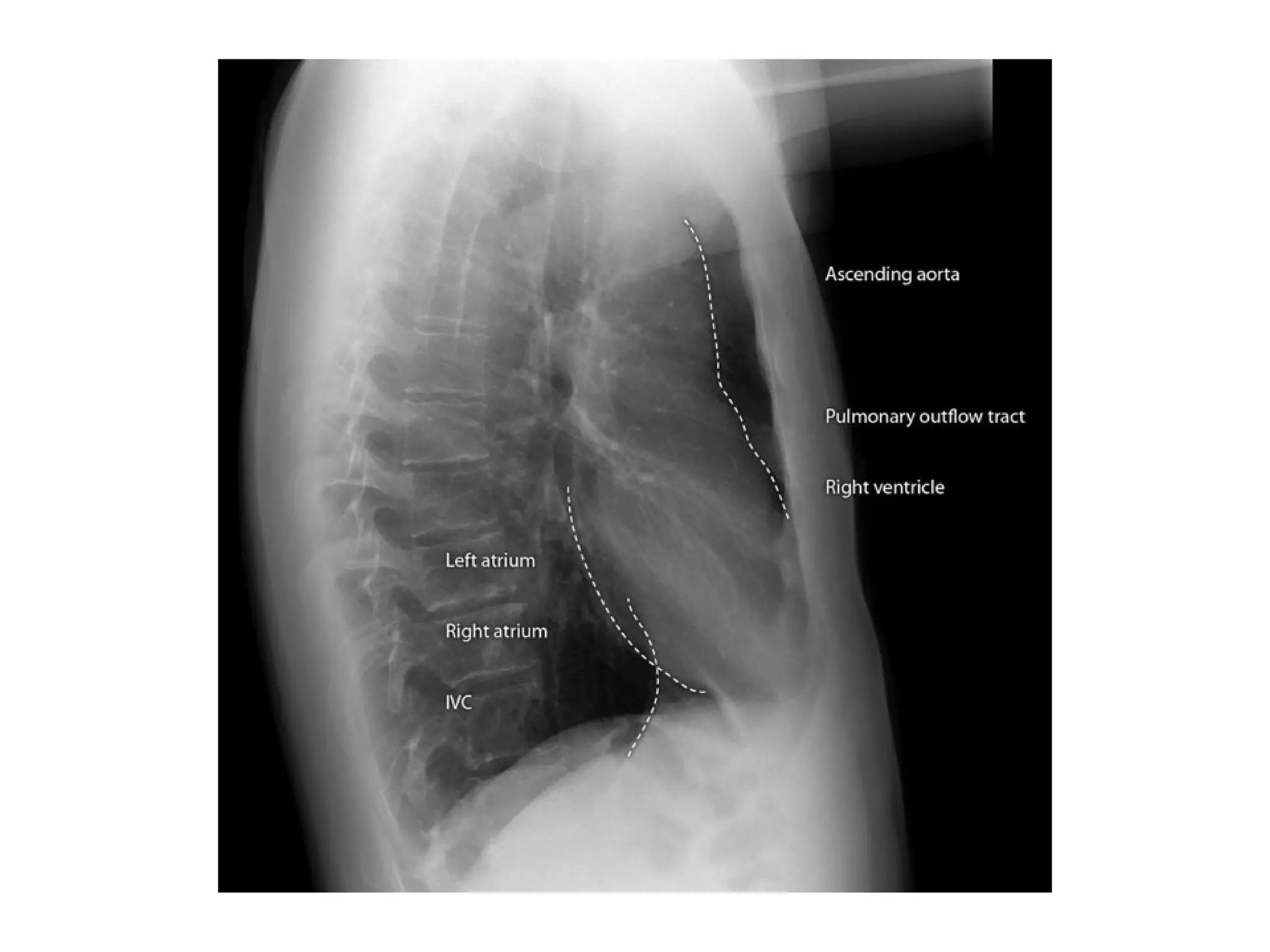 Chest X-rays Basic Interpretation | PPT