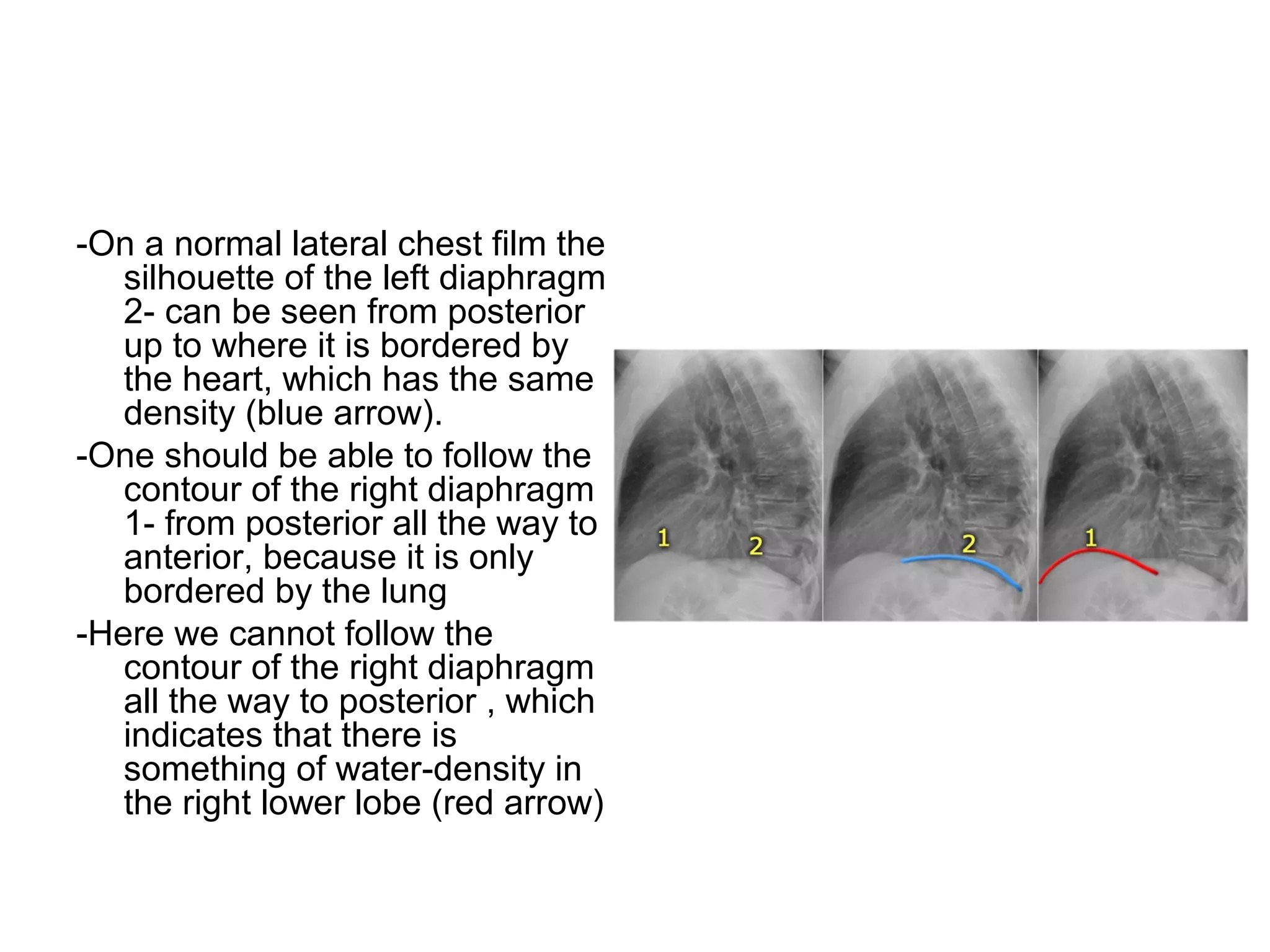 Chest X-rays Basic Interpretation | PPT