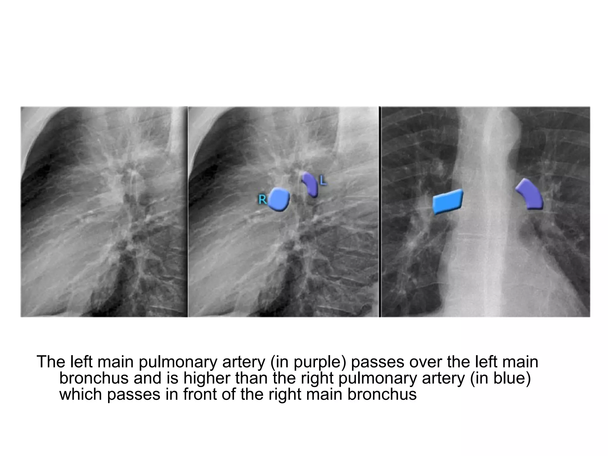 Chest X-rays Basic Interpretation | PPT