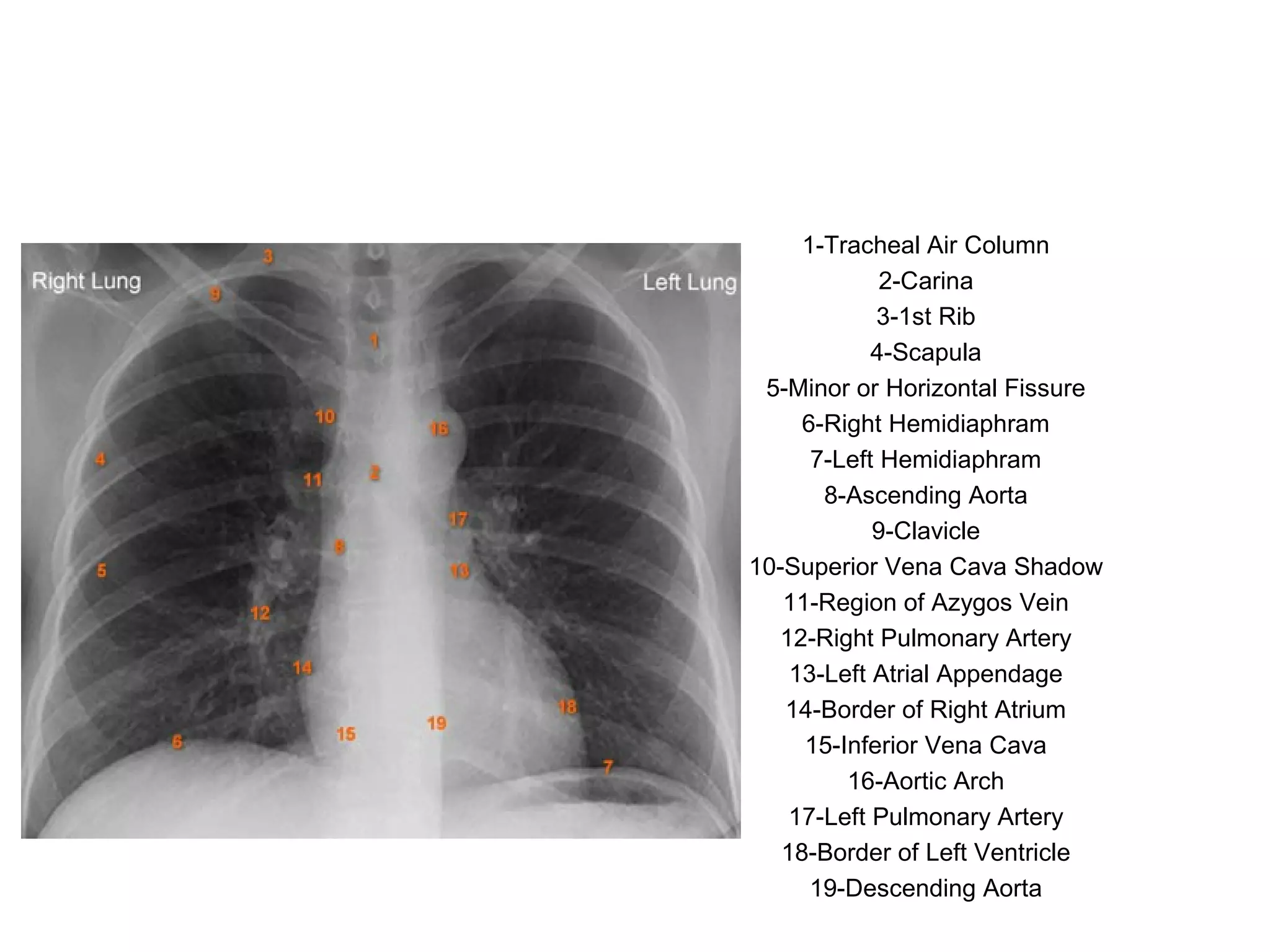 Chest X-rays Basic Interpretation | PPT