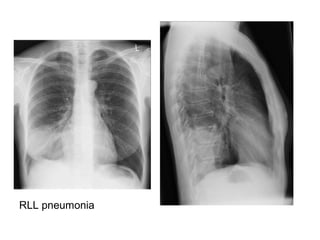 Chest X-rays Basic Interpretation | PPT