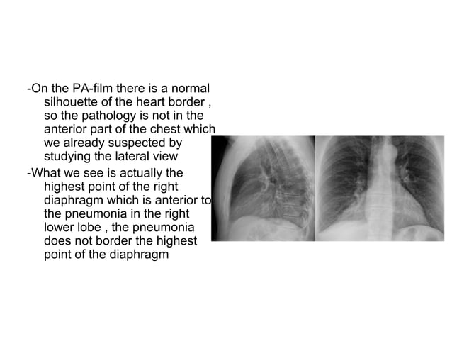 Chest X-rays Basic Interpretation | PPT