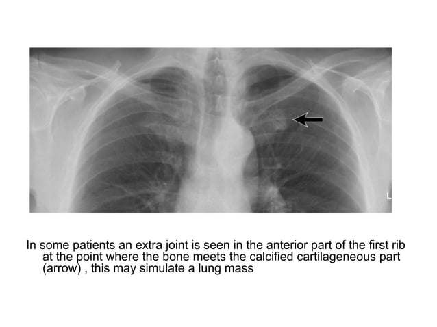 Chest X-rays Basic Interpretation | PPT