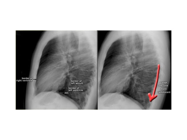 Chest X-rays Basic Interpretation | PPT