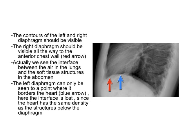 Chest X-rays Basic Interpretation | PPT