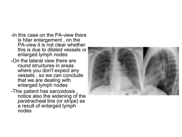 Chest X-rays Basic Interpretation | PPT