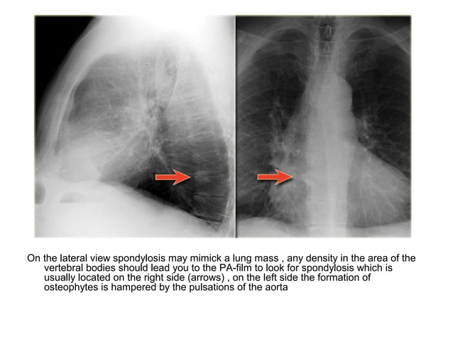 Chest X-rays Basic Interpretation | PPT