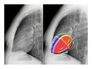 Chest X-rays Basic Interpretation | PPT