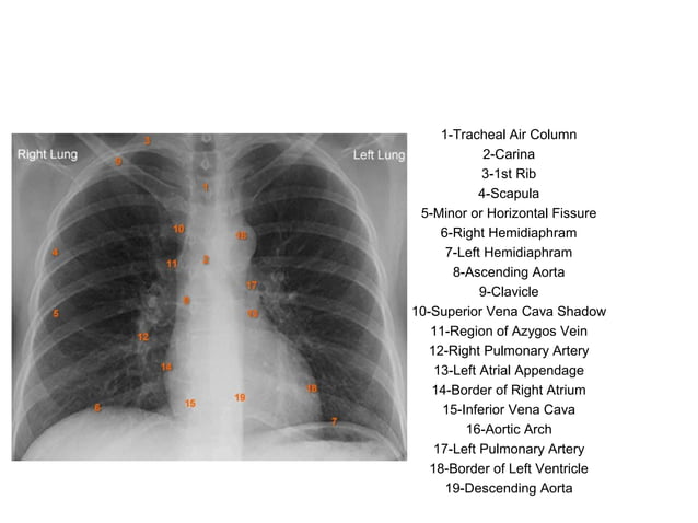 Chest X-rays Basic Interpretation | PPT