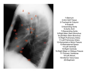 Chest X-rays Basic Interpretation | PPT