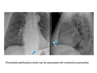 Chest X-rays Basic Interpretation | PPT