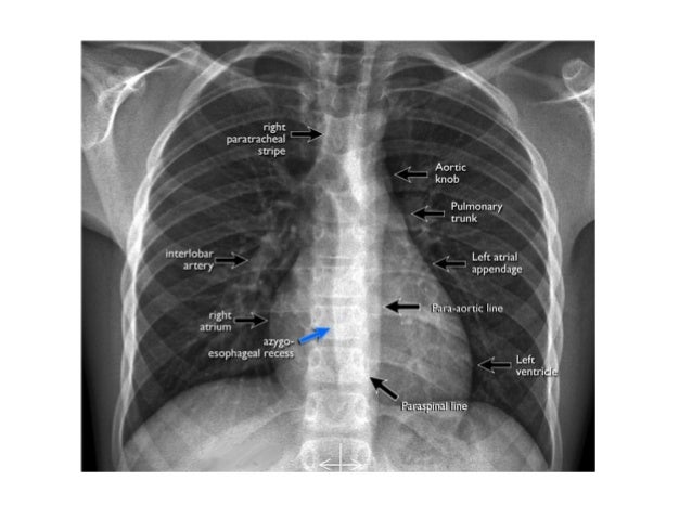 Chest X-rays Basic Interpretation