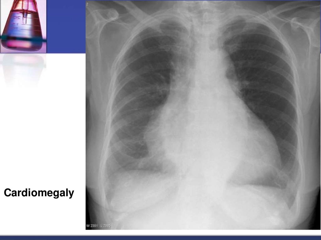 Normal chest x ray findings report - Deronestop