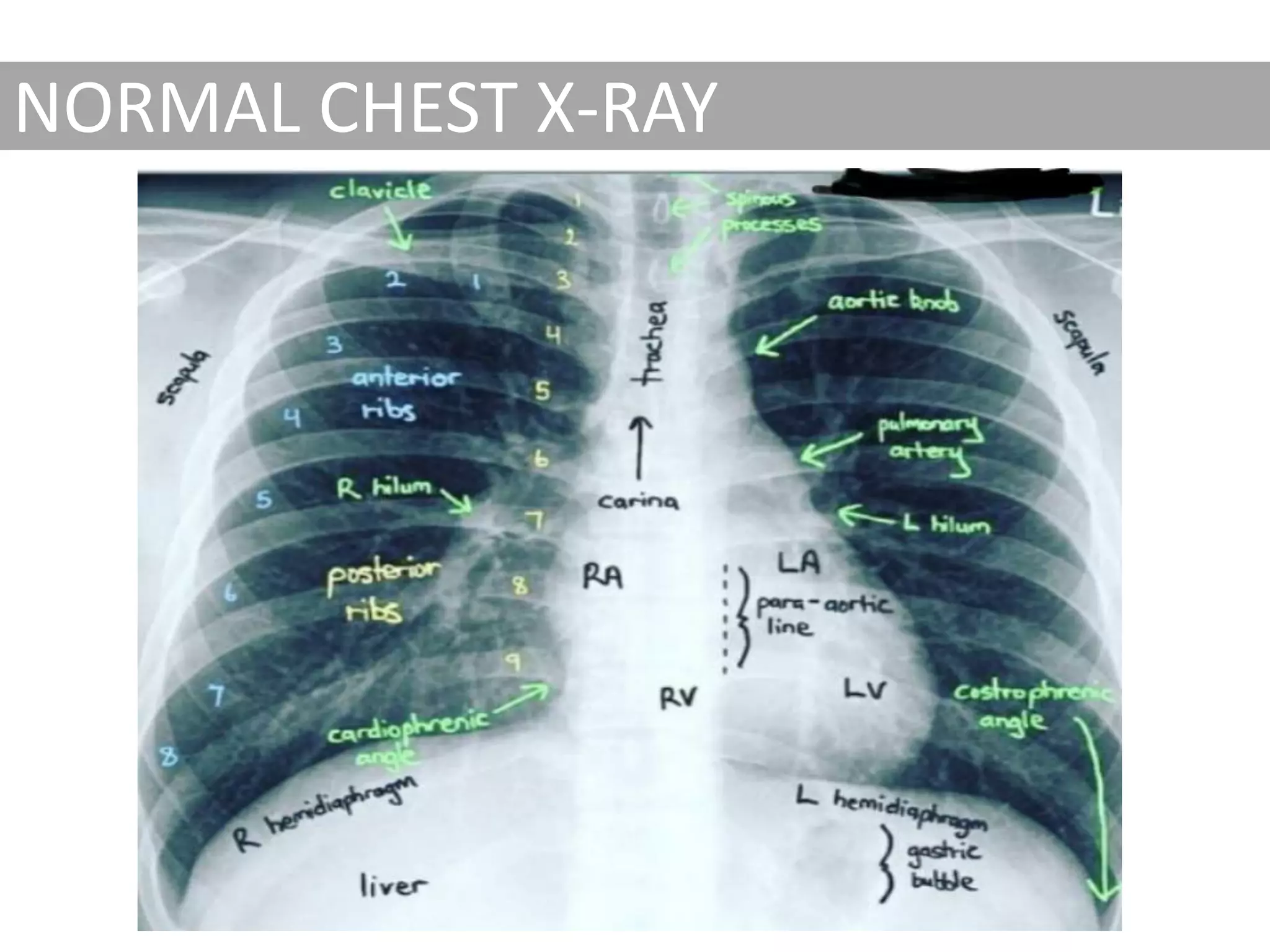 Easy guide to Chest x-ray Interpretation & Case Studies | PPTX