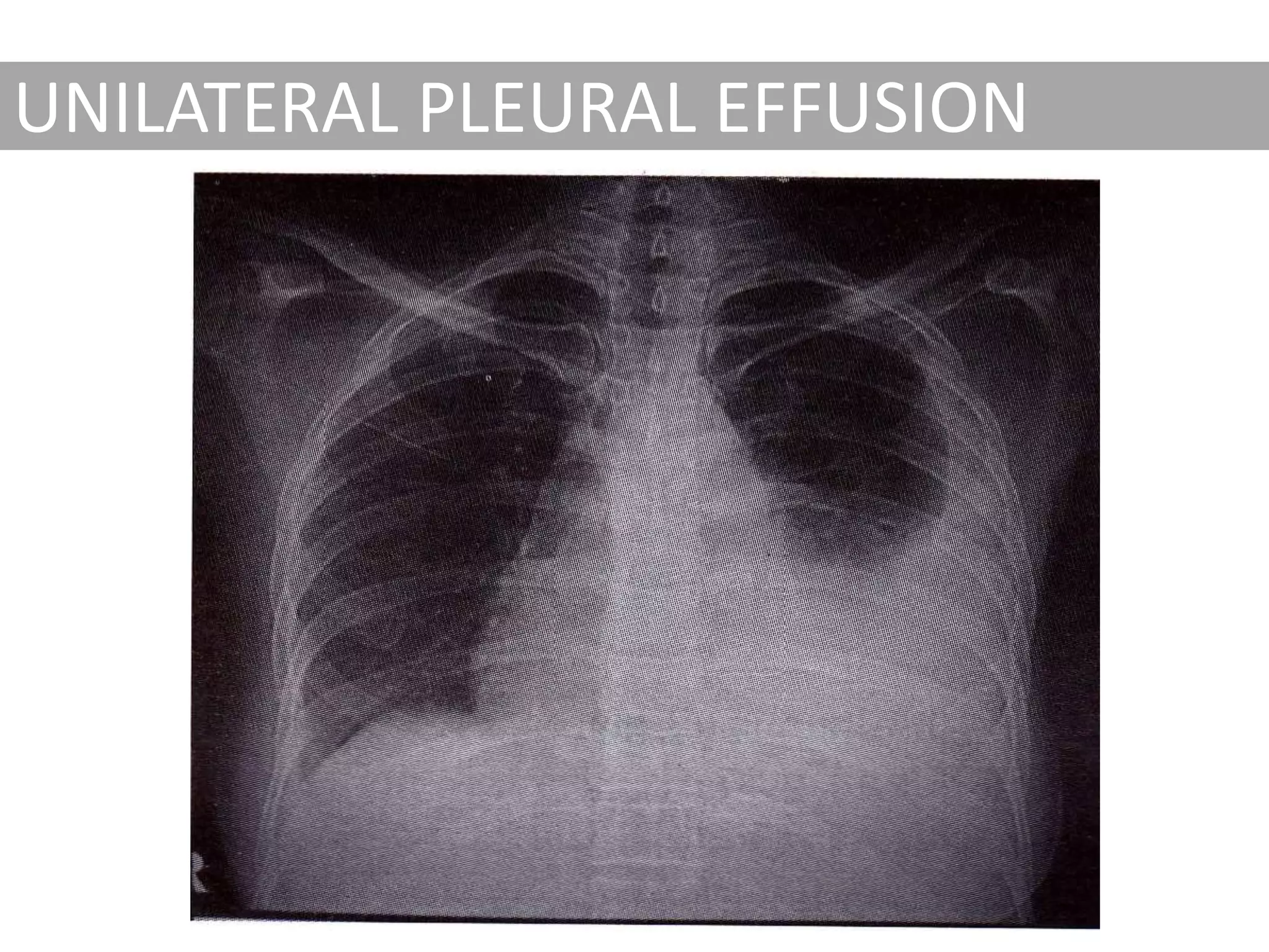 Easy guide to Chest x-ray Interpretation & Case Studies | PPTX