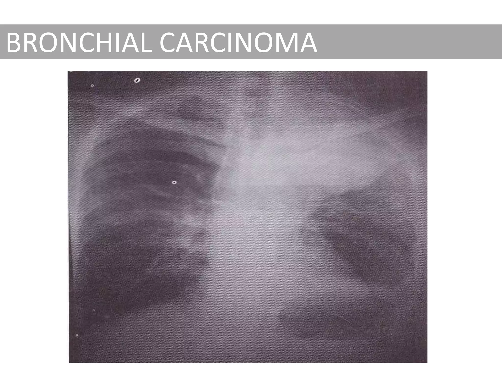 Easy guide to Chest x-ray Interpretation & Case Studies | PPTX