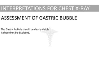 Easy guide to Chest x-ray Interpretation & Case Studies | PPTX