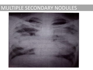 Easy guide to Chest x-ray Interpretation & Case Studies | PPTX