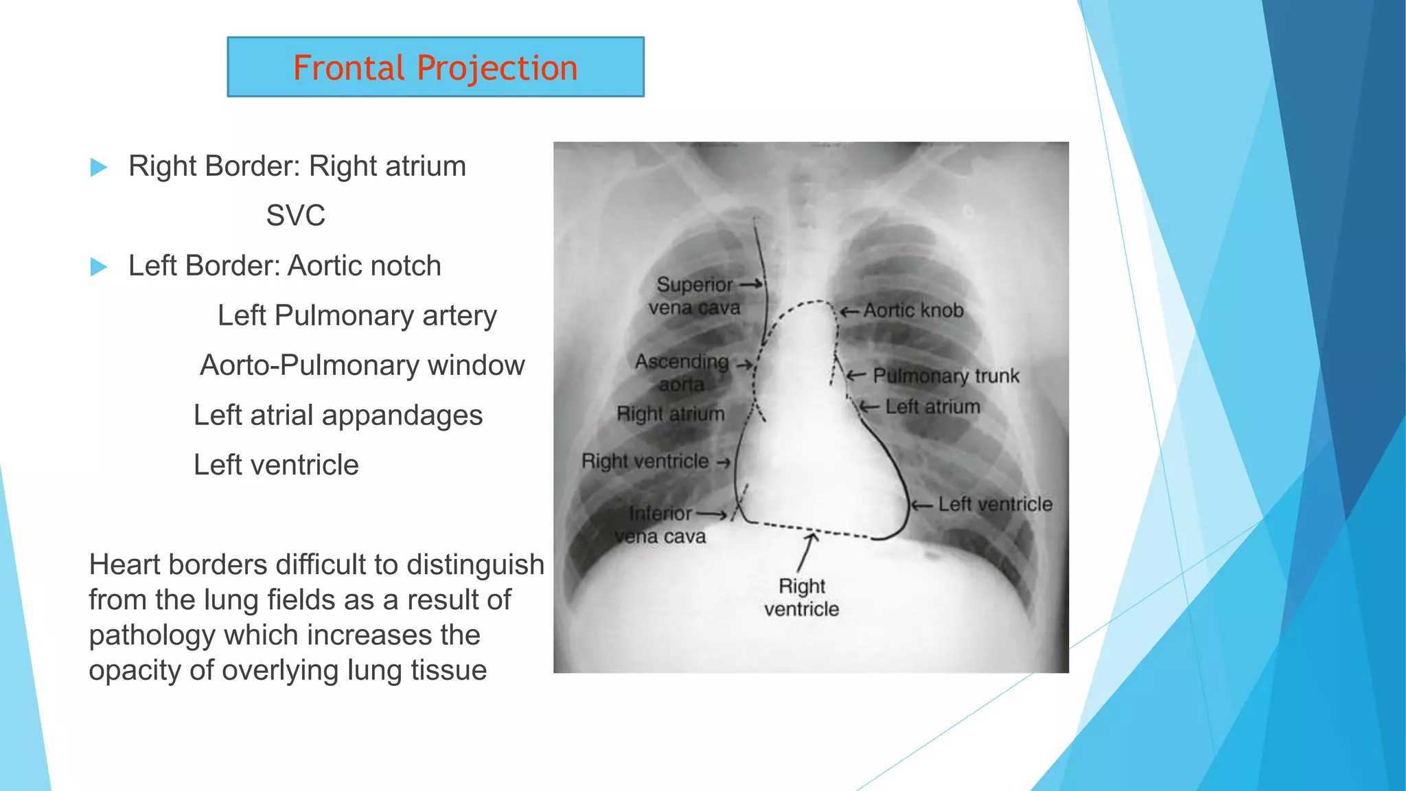 Paediatric Chest X-ray Interpretation | PPTX