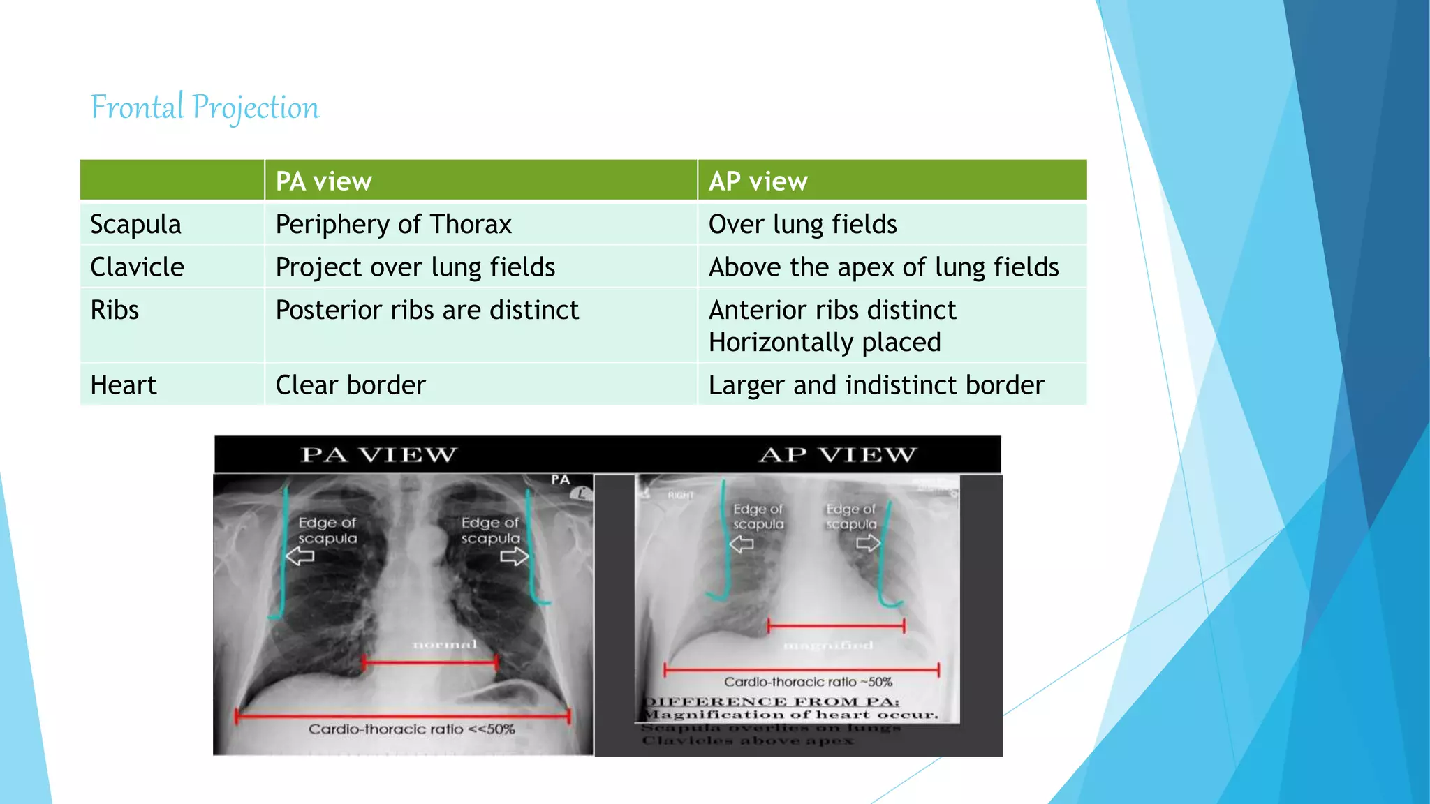 Paediatric Chest X-ray Interpretation | PPTX