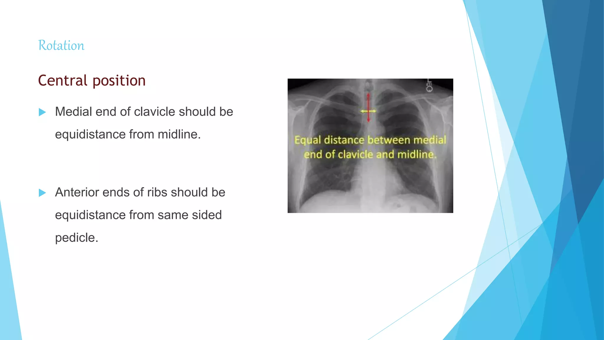 Paediatric Chest X-ray Interpretation | PPTX