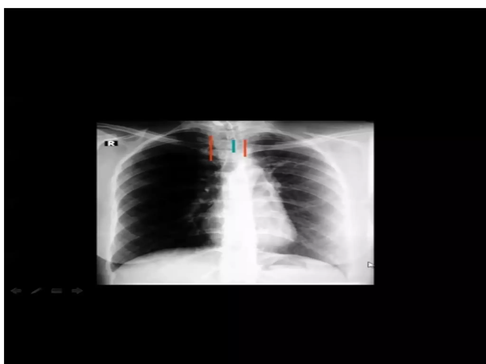 Chest x-ray interpretation.pdf