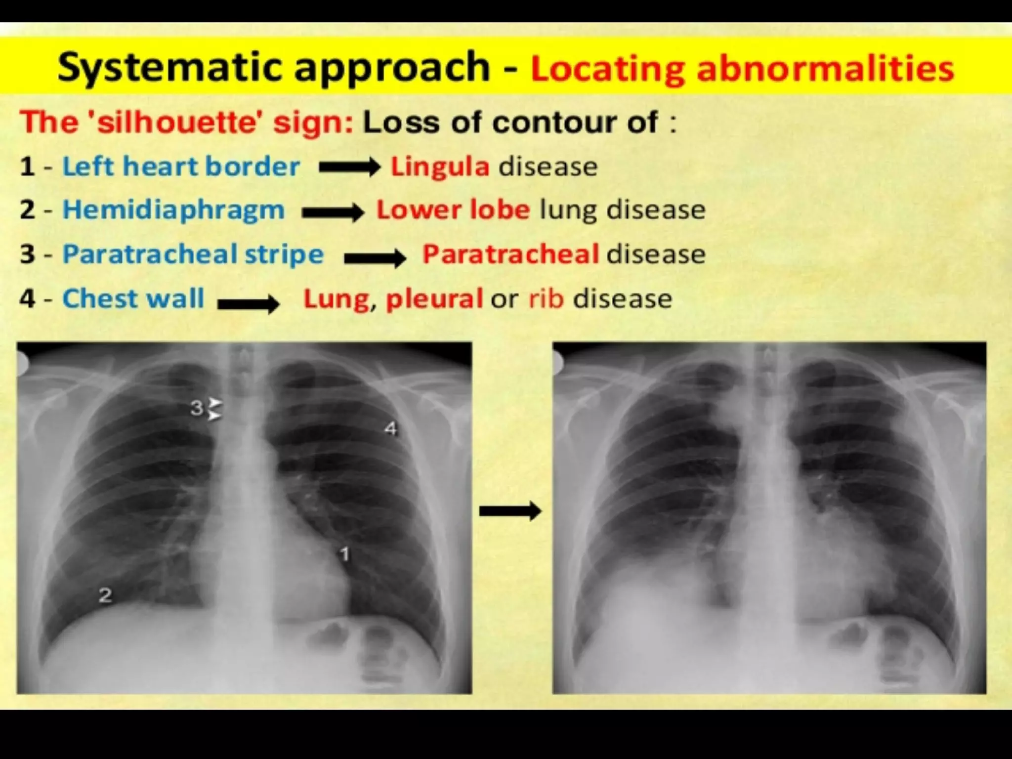 Chest x-ray interpretation.pdf