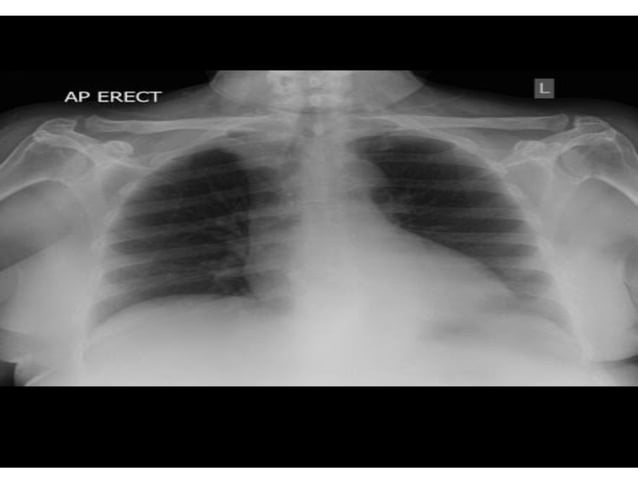 Chest x-ray interpretation.pdf