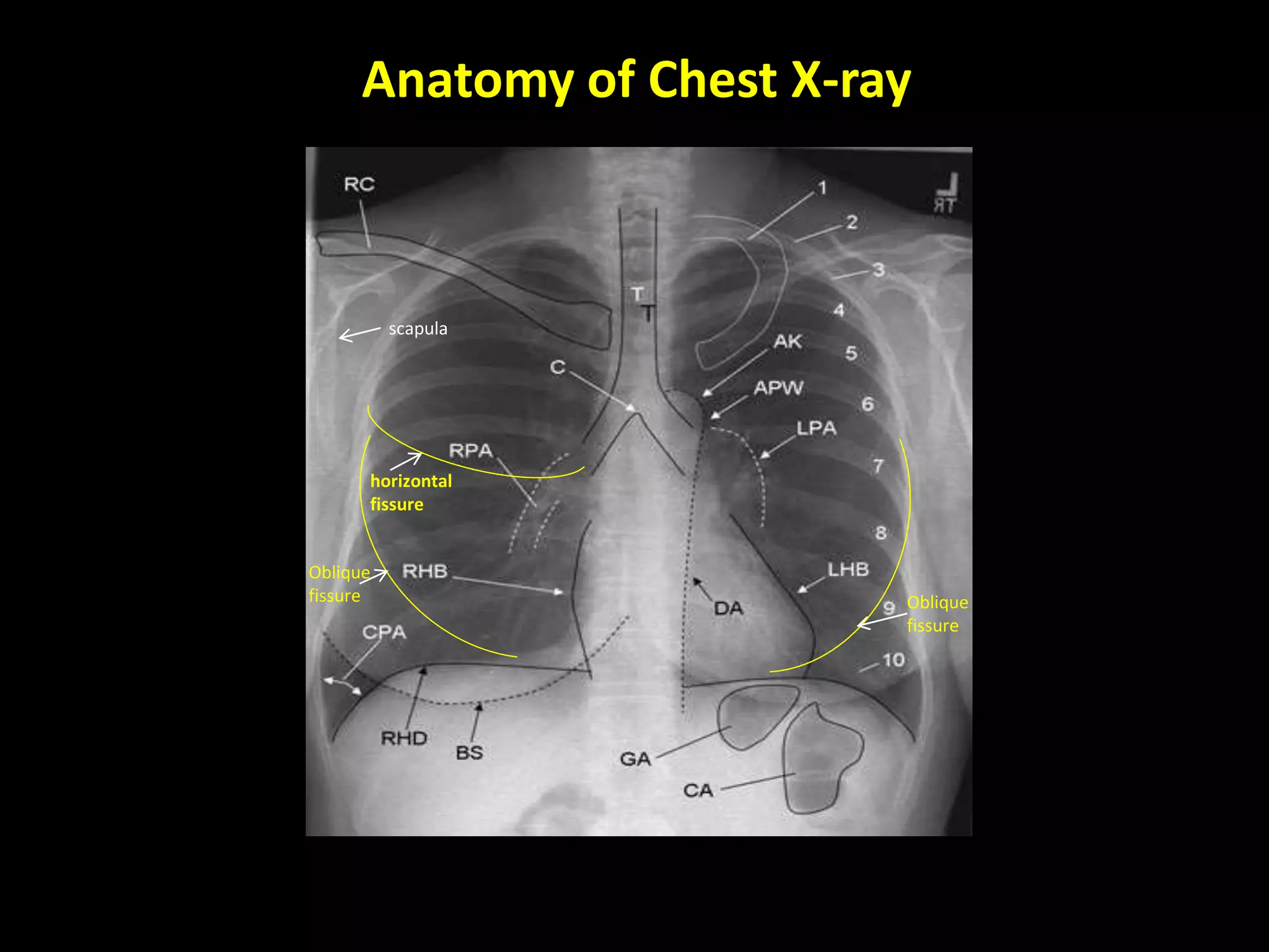 Chest X-ray Interpretation.pptx