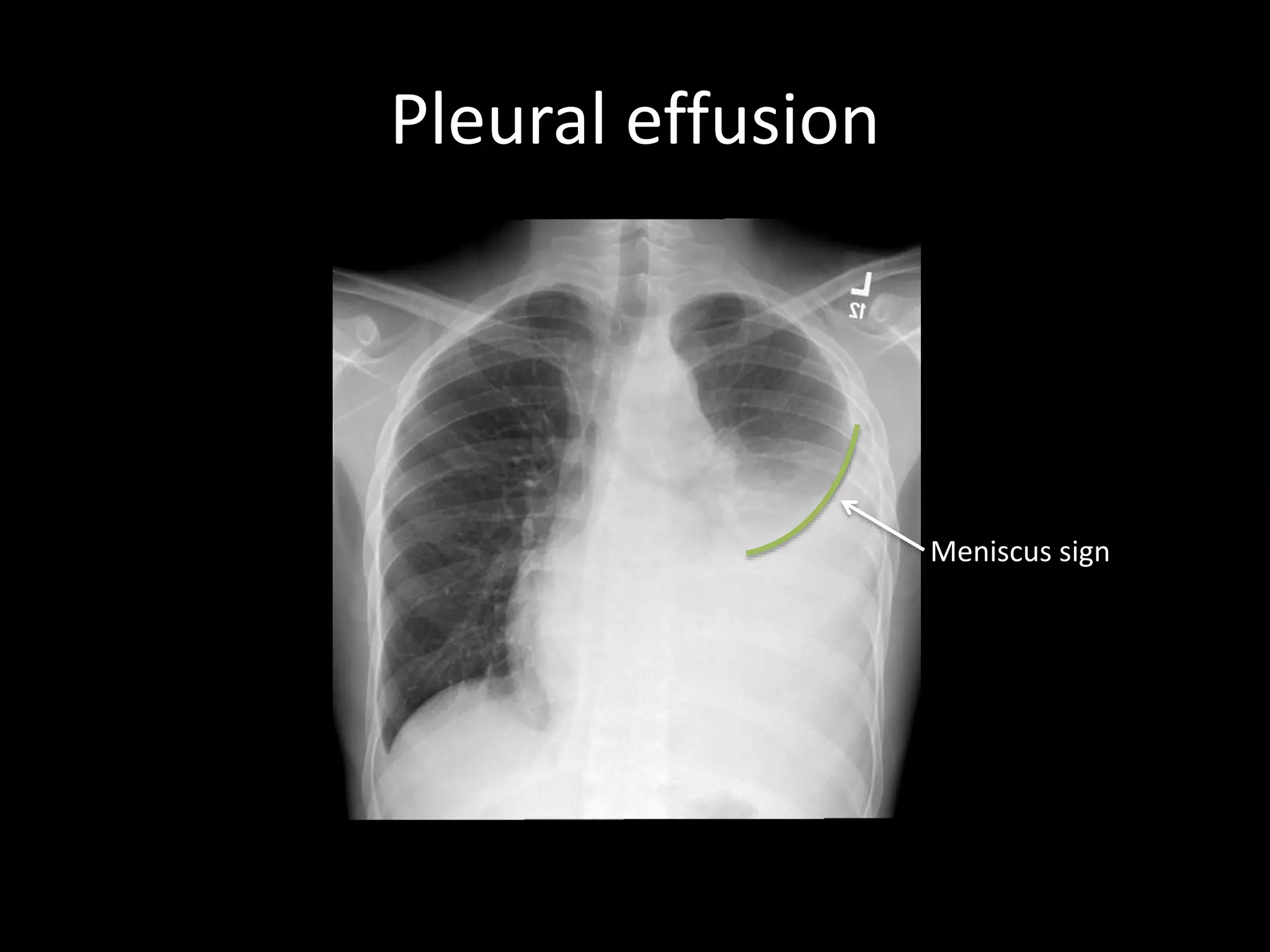 Chest X-ray Interpretation.pptx