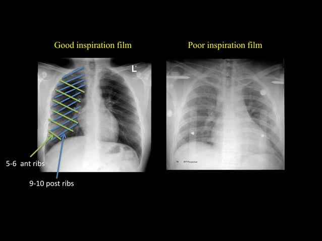 Chest X-ray Interpretation.pptx