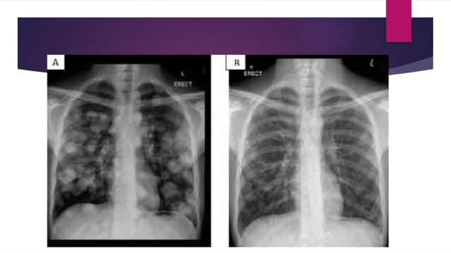 Chest X-Ray Interprvjbbbhbbhvvetation.pptx