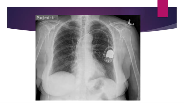 Chest X-Ray Interprvjbbbhbbhvvetation.pptx
