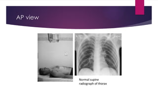 Chest X-Ray Interprvjbbbhbbhvvetation.pptx