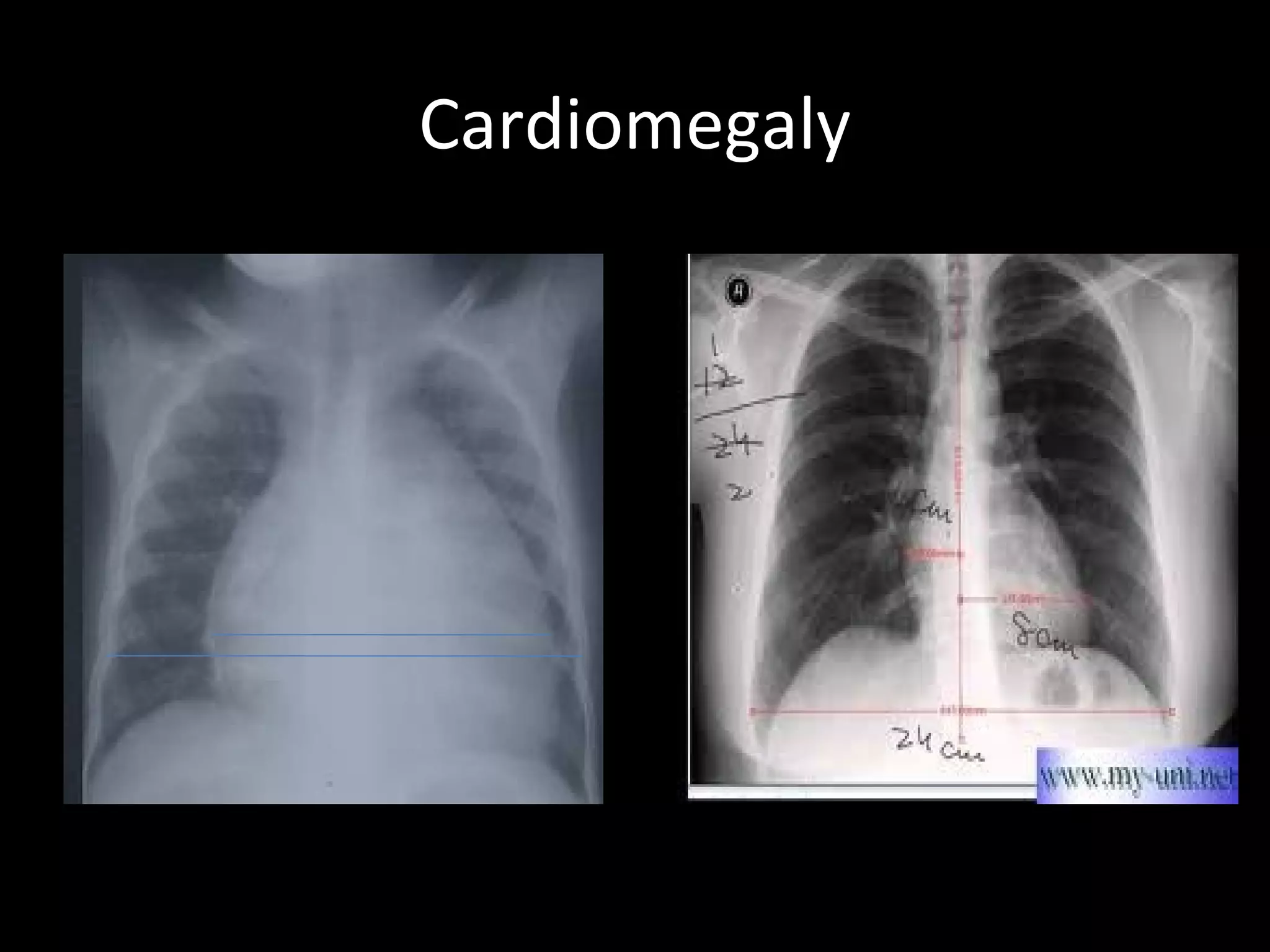 Chest x ray interpretation in OMF surgery | PPT