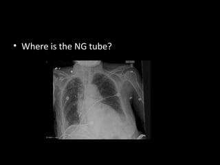 Chest x ray interpretation in OMF surgery | PPT