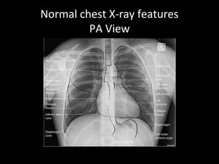 Chest x ray interpretation in OMF surgery | PPT