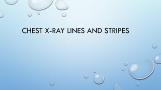 Chest x-ray Lines and stripes.pptx useful for residents | PPTX