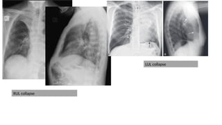 CHEST X-RAY lung disease.pptx from dr mohamed | PPTX