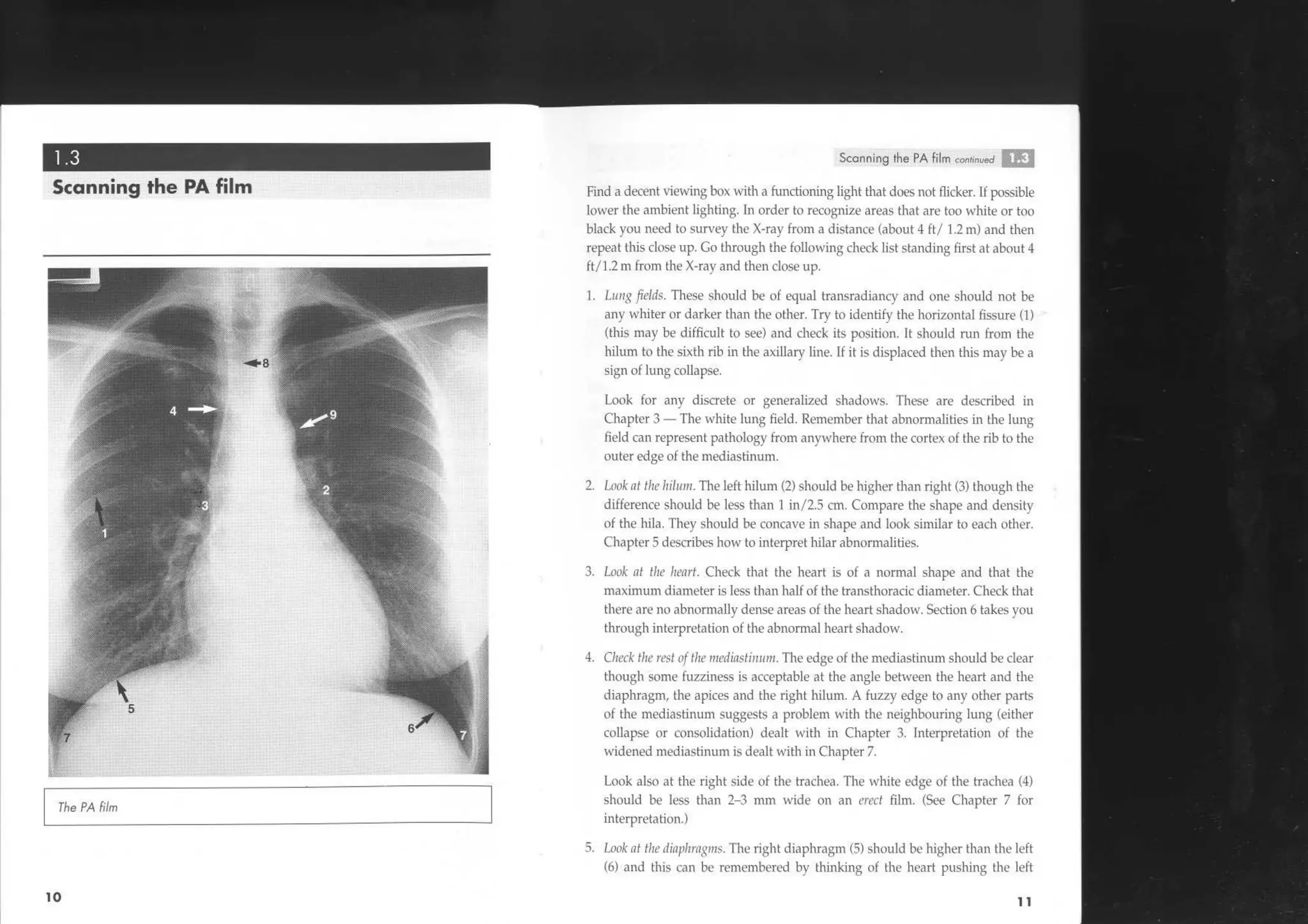 Chest x ray made easy | PDF