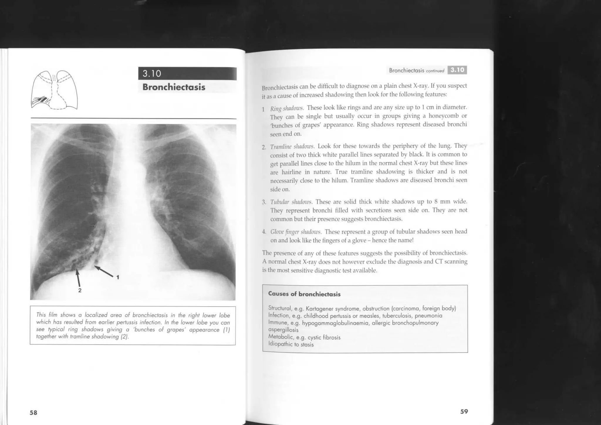 Chest x ray made easy | PDF
