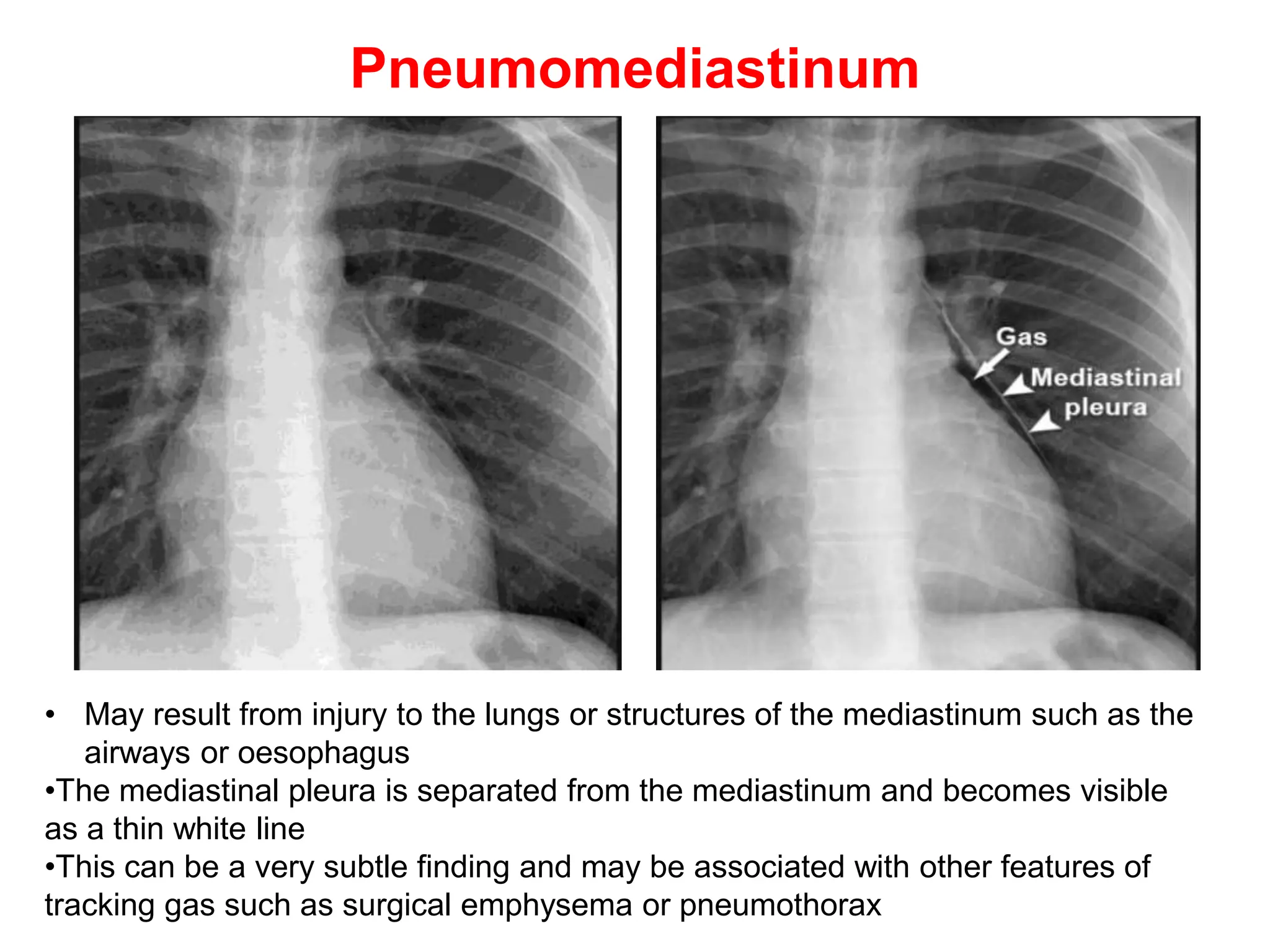 CHEST X-RAY MEDIASTINUM AND HILUMpptx.pptx