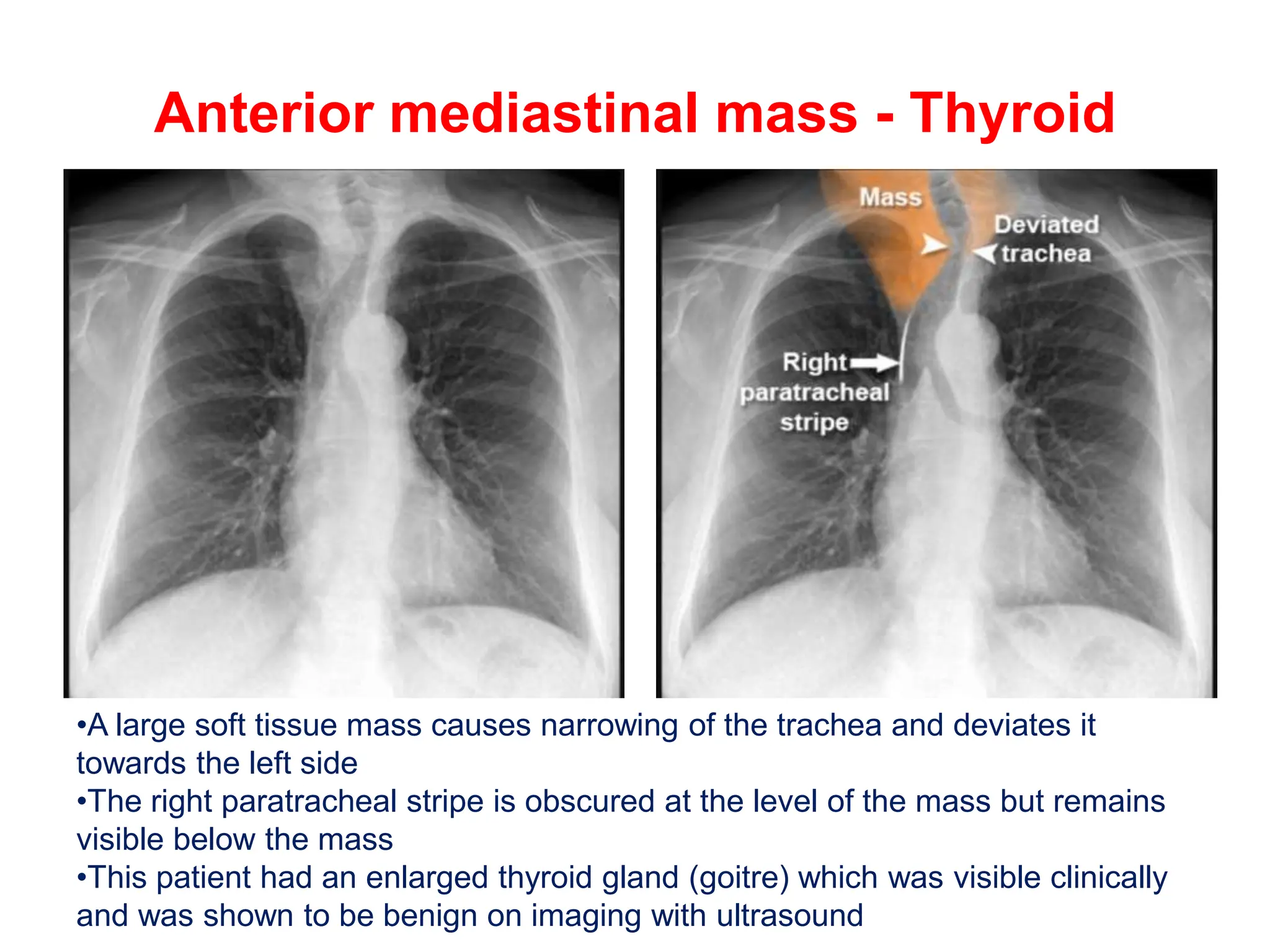CHEST X-RAY MEDIASTINUM AND HILUMpptx.pptx