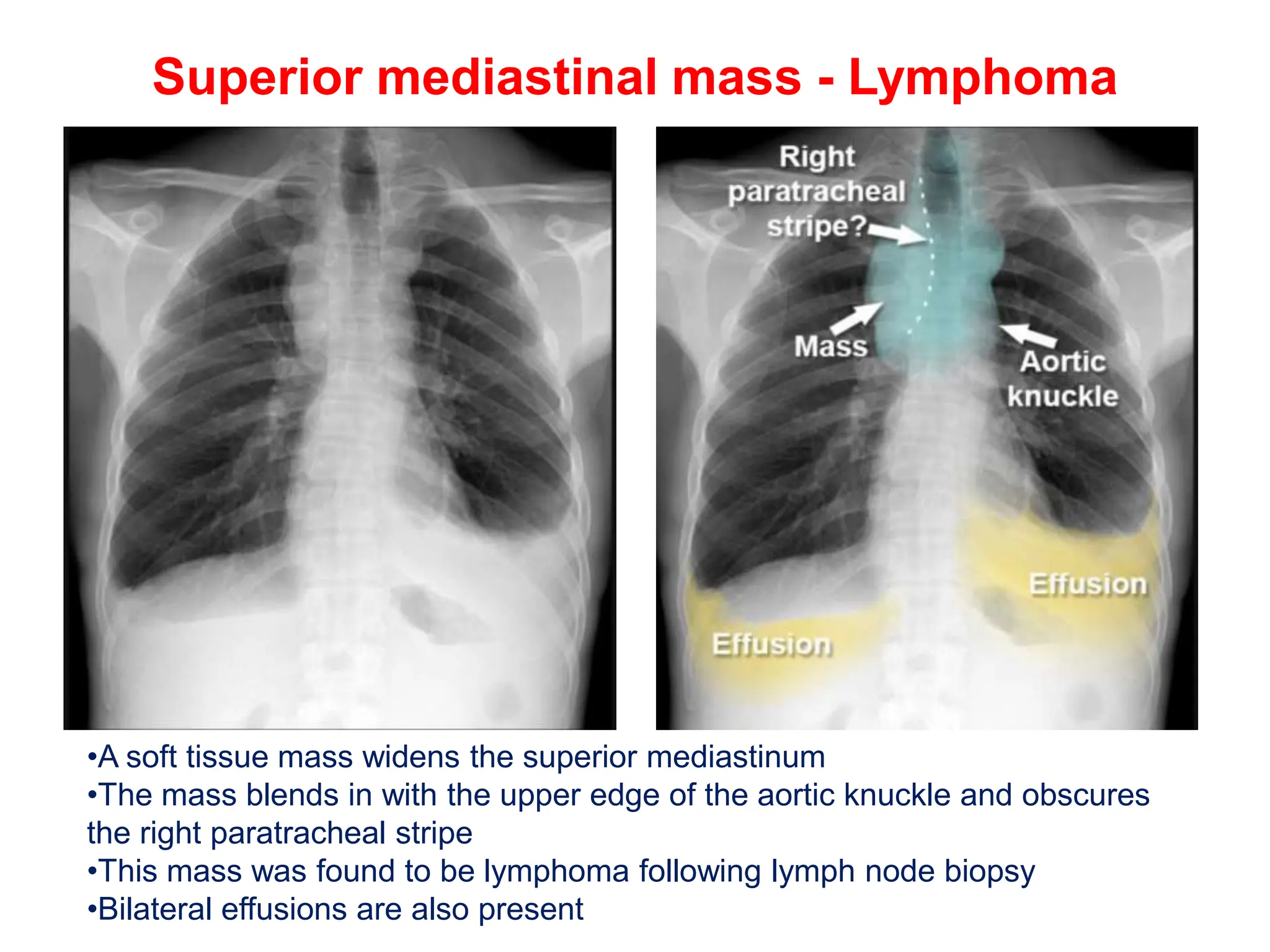CHEST X-RAY MEDIASTINUM AND HILUMpptx.pptx