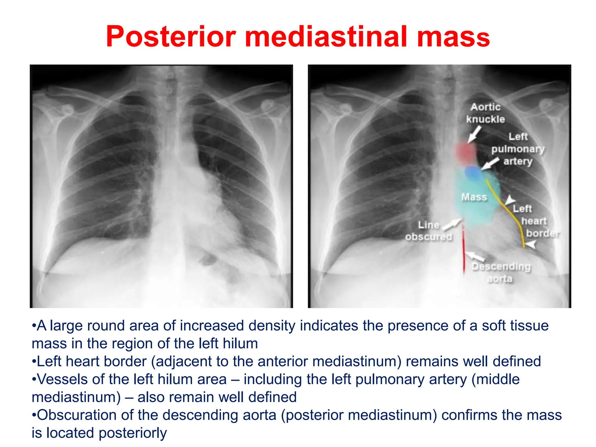 CHEST X-RAY MEDIASTINUM AND HILUMpptx.pptx