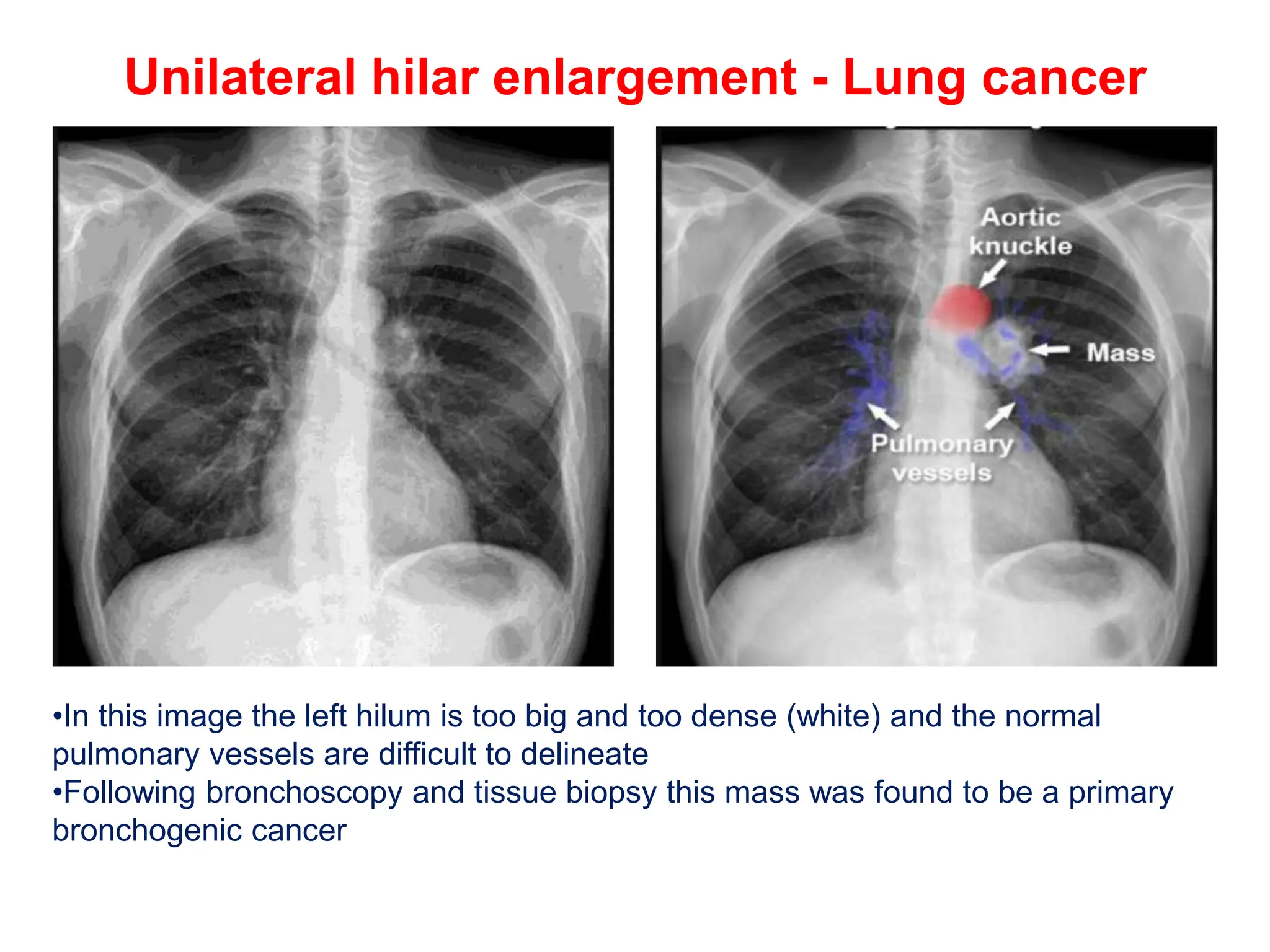 CHEST X-RAY MEDIASTINUM AND HILUMpptx.pptx