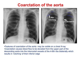 CHEST X-RAY MEDIASTINUM AND HILUMpptx.pptx