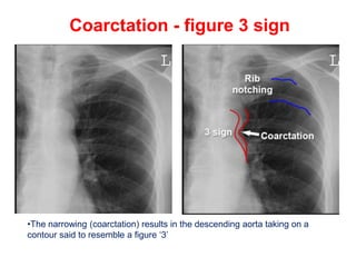 CHEST X-RAY MEDIASTINUM AND HILUMpptx.pptx