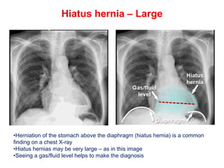 CHEST X-RAY MEDIASTINUM AND HILUMpptx.pptx